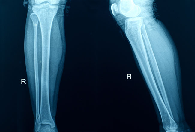 Common Causes of Shin Pain | York Foot Orthotics and Bracing